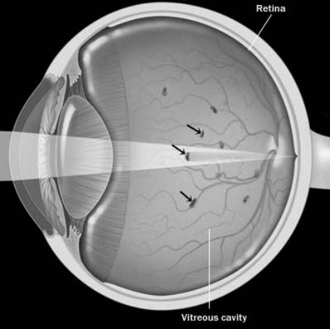 Floaters: So what are those damned moving amoeba things in your eyes ...