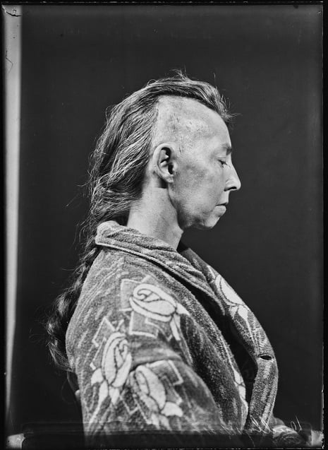Beautiful portraiture of the very first brain surgery patients