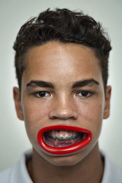 HyperLip: Plastic prosthesis lips to give you that totally batshit ...
